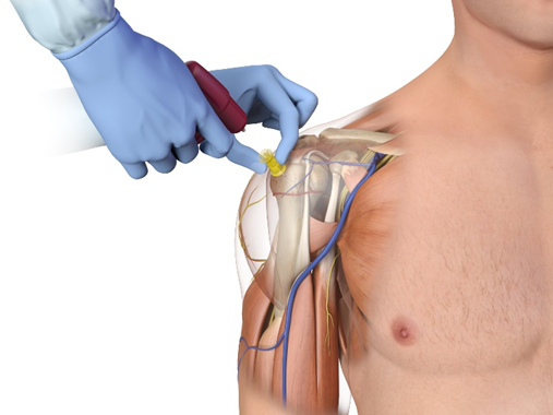 EZ-IO® Proximal Humerus Identification & Insertion Technique – Adult ...
