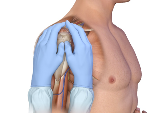 EZ-IO® Proximal Humerus Identification & Insertion Technique – Adult ...